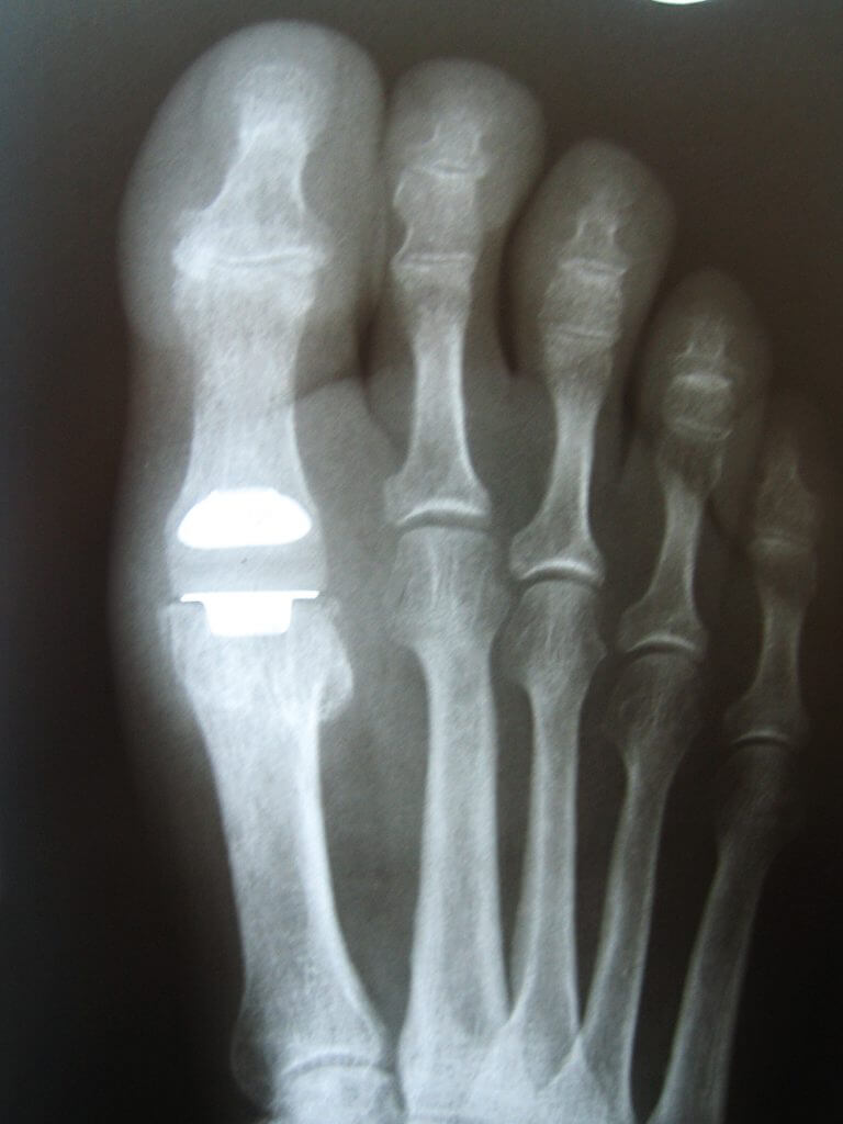 Hallux Rigidus - Orthopress | Das neue Onlineportal rund um Ihre Gesundheit