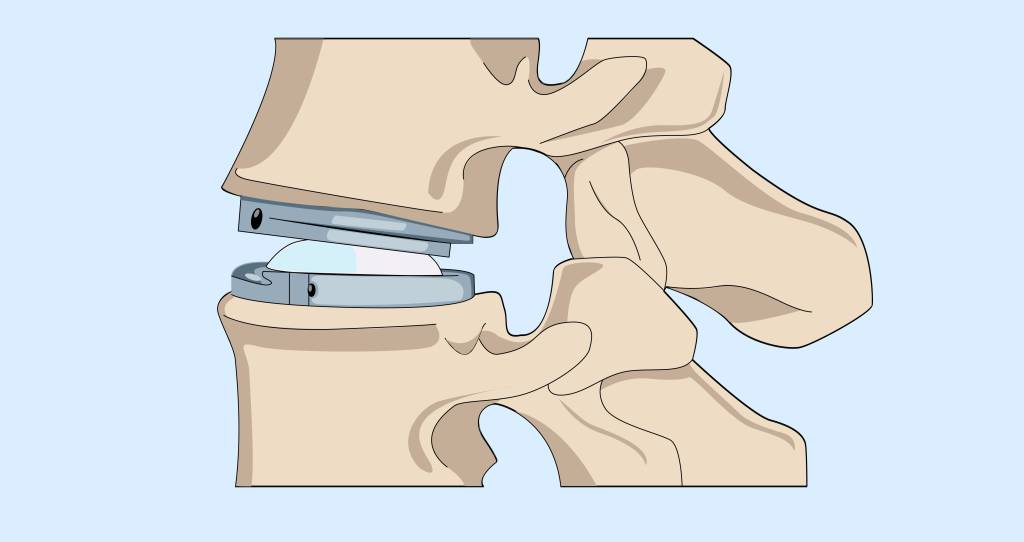 Bandscheibenprothese - Orthopress | Das neue Onlineportal rund um Ihre ...